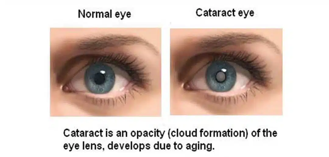 Ophthalmology Acupuncture - ACA Acupuncture and Wellness