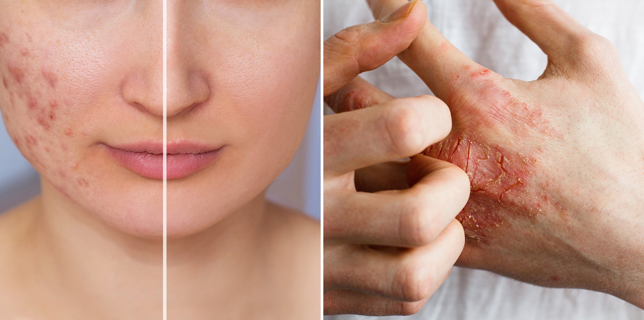 ACA Acupuncture and Wellness Centers in New York City, California, & NJ