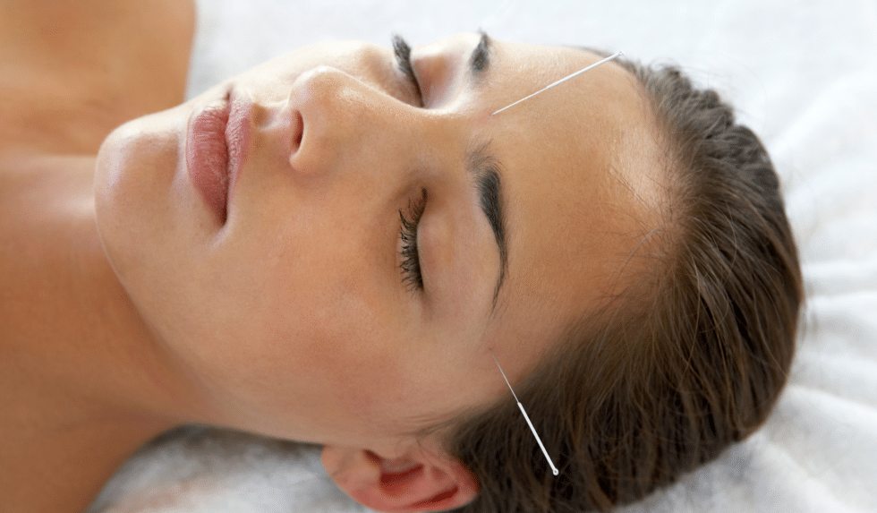 Acupuncture for Headaches and Migraines | ACA Acupuncture and Wellness