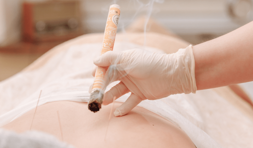 Exploring Moxibustion in Acupuncture: Benefits, Uses, and What to Expect