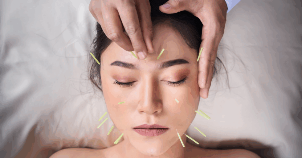 What Is Facial Acupuncture? Benefits, Results, and How It Works