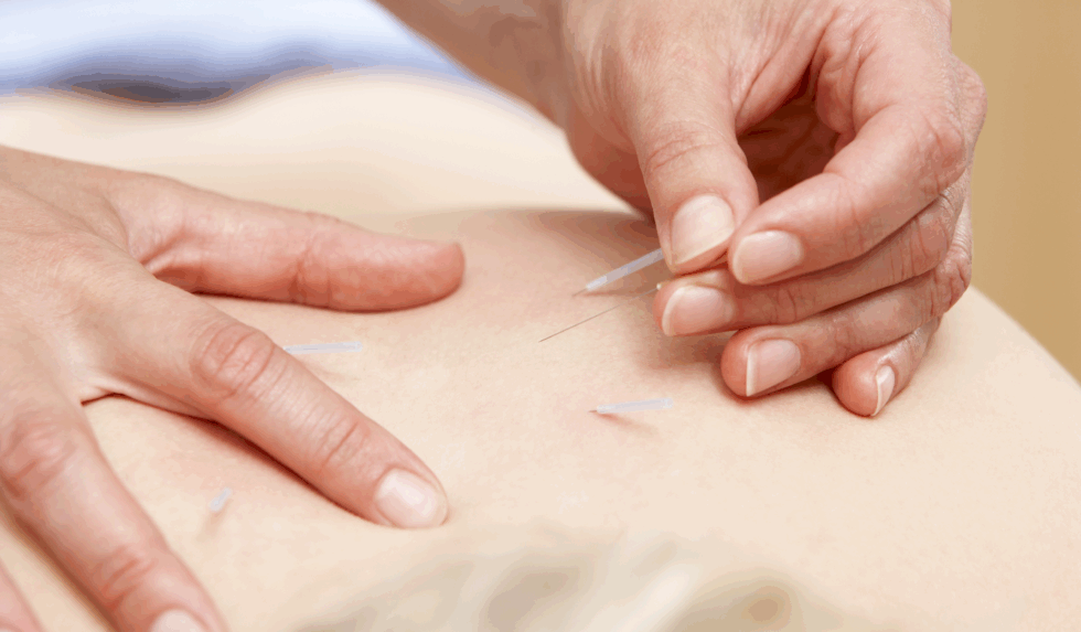 How to Become an Acupuncturist?