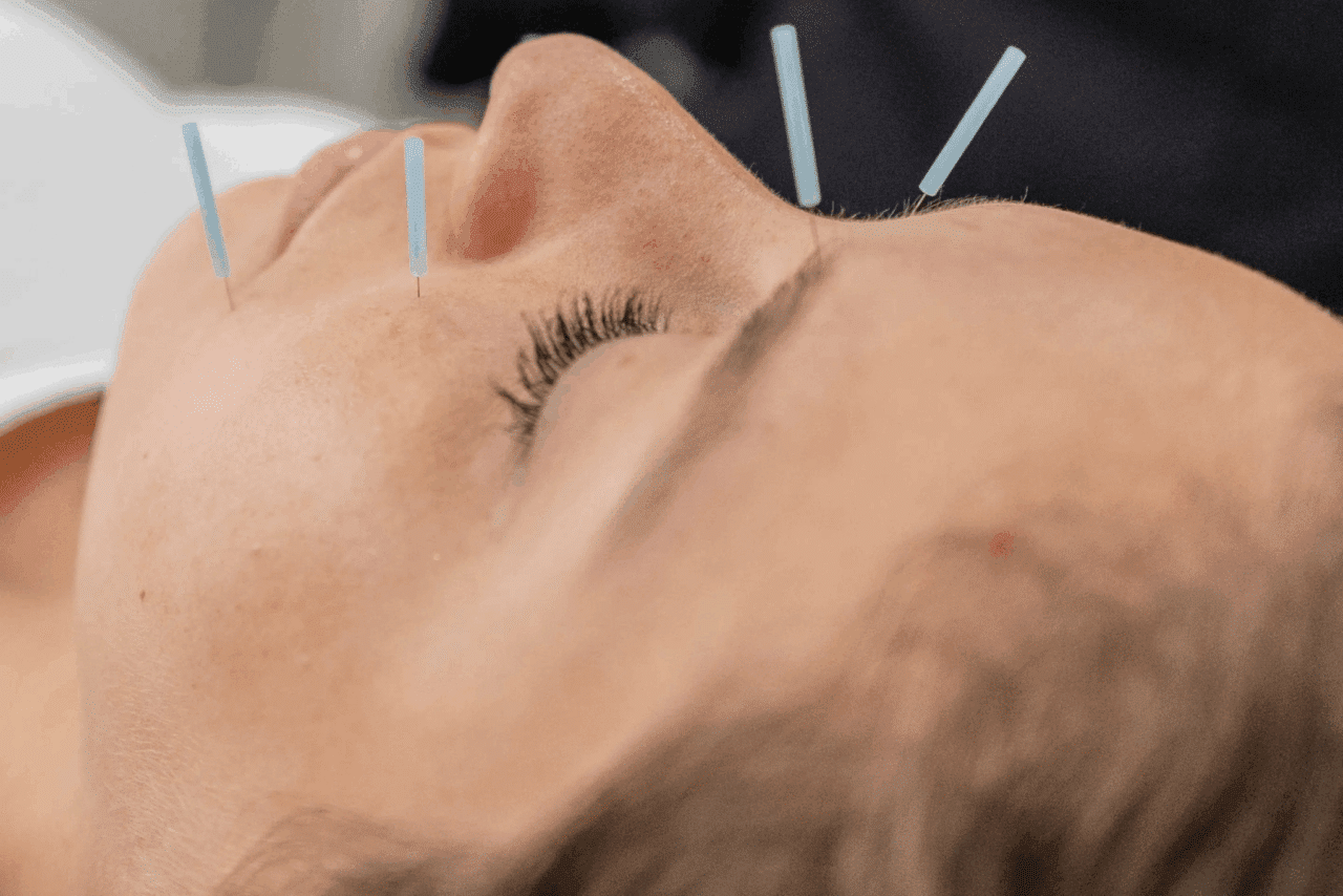Facial Acupuncture NYC - ACA Acupuncture and Wellness | Acupuncture ...